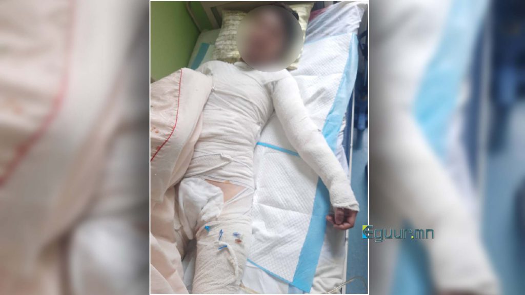 27 настай хохирогч залуу эхний хагалгаандаа оржээ - Eguur.MN